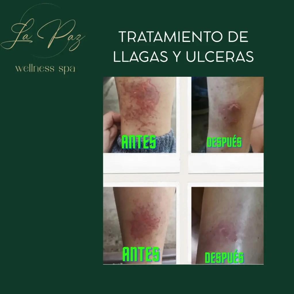 Tratamiento de Llagas | lapazwellnessandspa